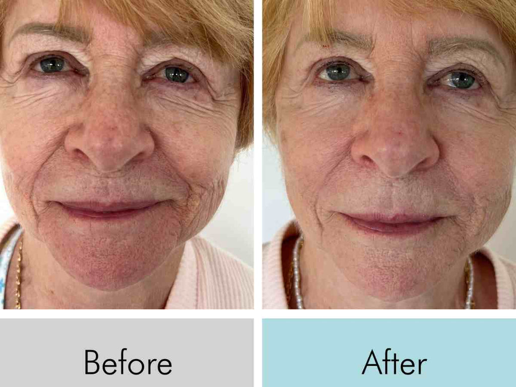 Red Light Mask Before & After Results: Real Skin Transformations