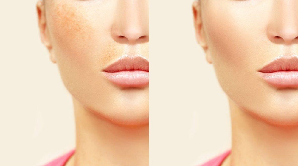 What causes discoloration of the skin