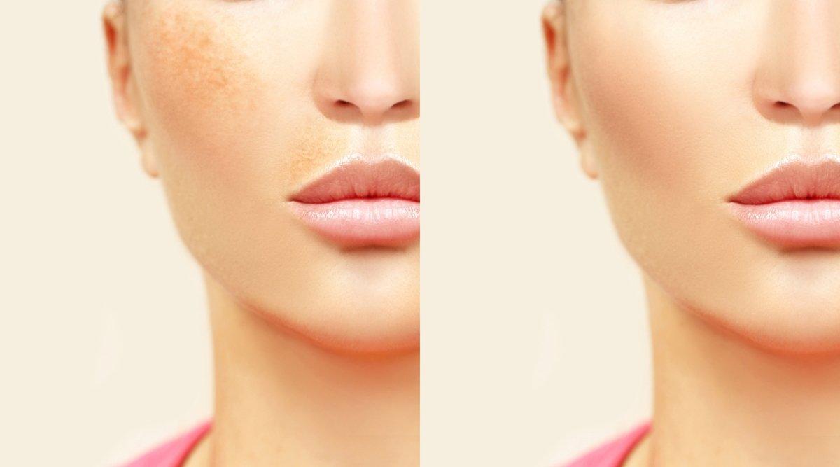 What results in skin discoloration?