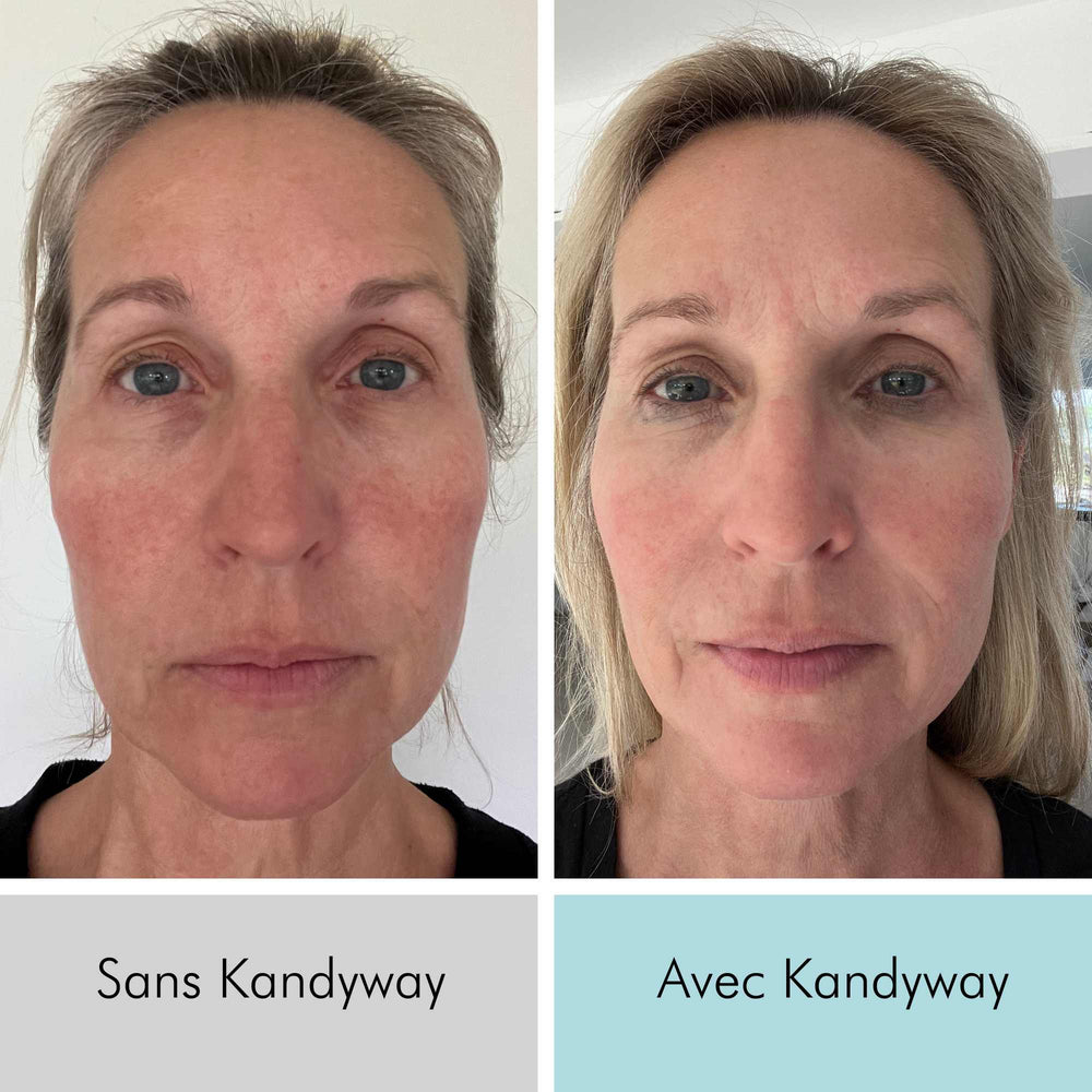Réduisez les rides et les taches de vieillesse avec la luminothérapie de qualité clinique Kandyway
